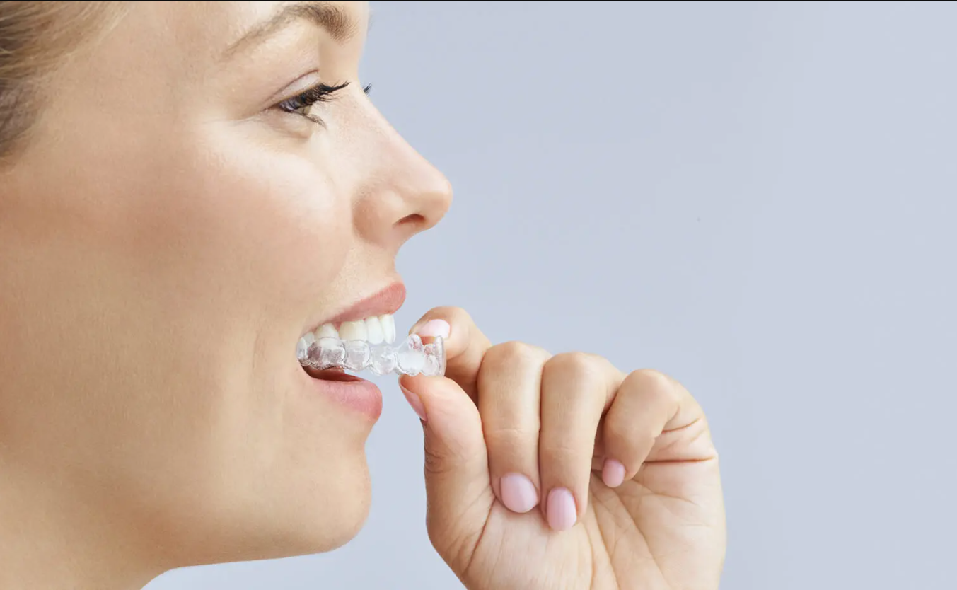 Invisalign Crowded Teeth in Forest Hill